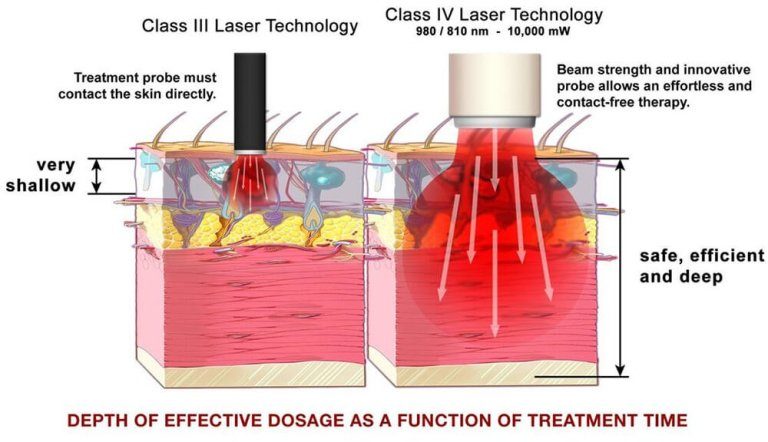 Class III Vs Class IV Laser Therapy - Qolight Medical Laser